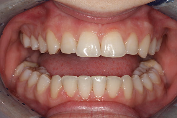 case-03-aligners-after - Sleep Lane Smiles