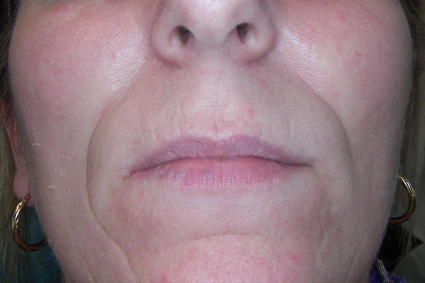 case-12-nose-mouth-lines-befor - Sleep Lane Smiles